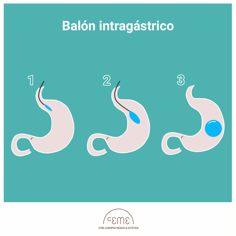 Balón Intragástrico: el método para perder peso y no recuperarlo