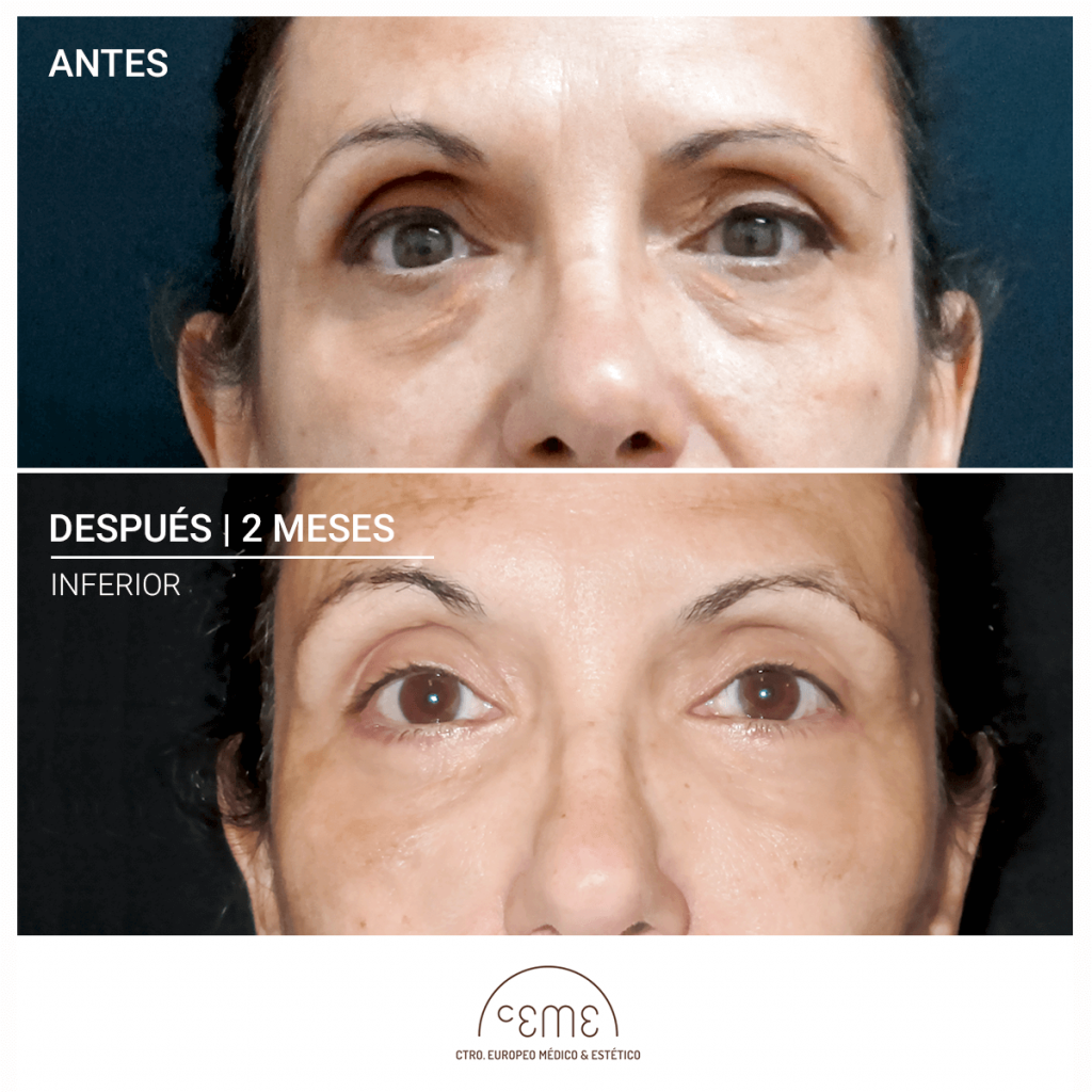 CEME - Blefaroplastia