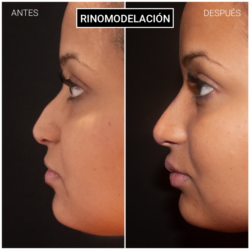 ¿rinoplastia O Rinomodelación Ceme