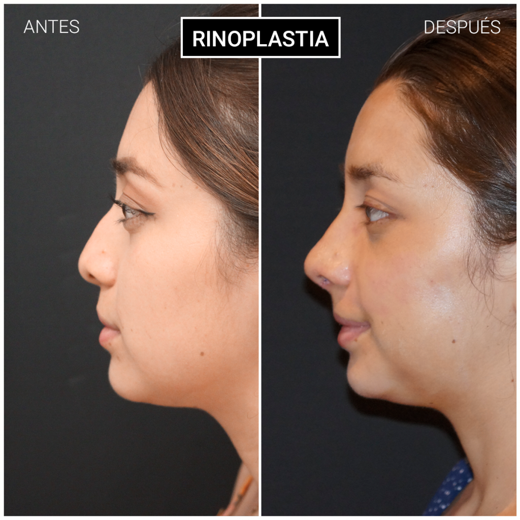 ¿rinoplastia O Rinomodelación Ceme