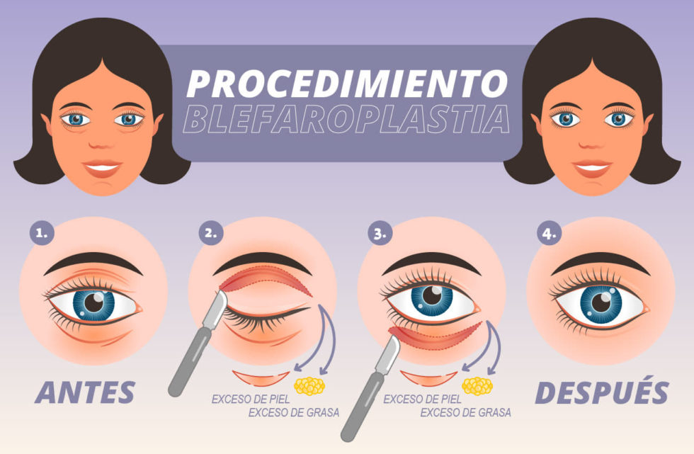 Solución para los Párpados Caídos - Ceme