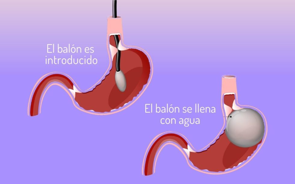 Pérdida de peso con Balón Intragástrico - Ceme